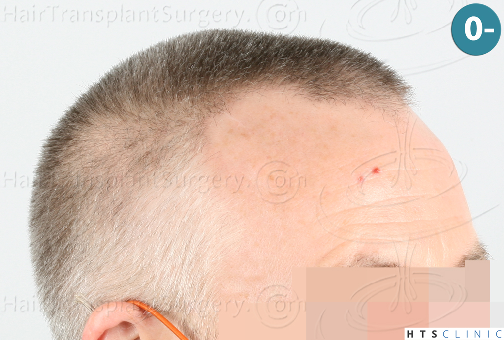 Dr Jean Devroye Hts Clinic 2052 Fue Hairline Restoration